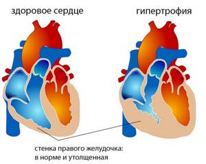 Right ventricular hypertrophy: ECG signs, symptoms, what it is and how ...