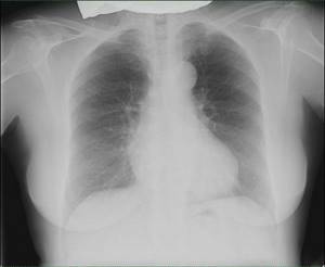 What does fluorography of the lungs and other chest organs show?
