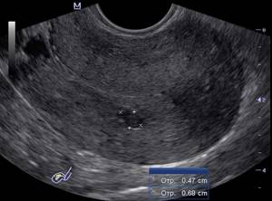 Treatment of cervical cysts, medicinal and surgical. Why do Nabothian ...