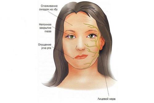 Neuritis of the facial nerve: symptoms, treatment of inflammation of ...